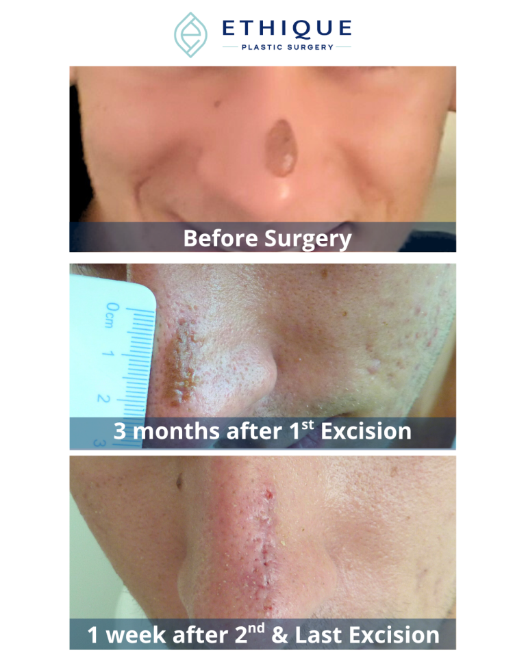 Serial Excision – Removing Large Skin Lesions | Ethique Plastic Surgery